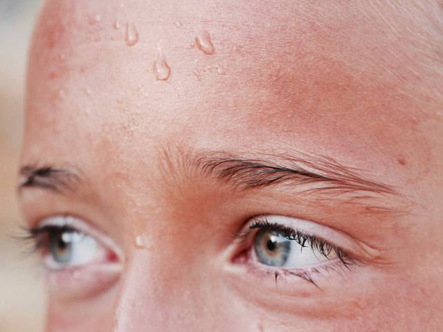 Dermatologist Predicts Mass Sweating Problems As Temperatures Rise ...